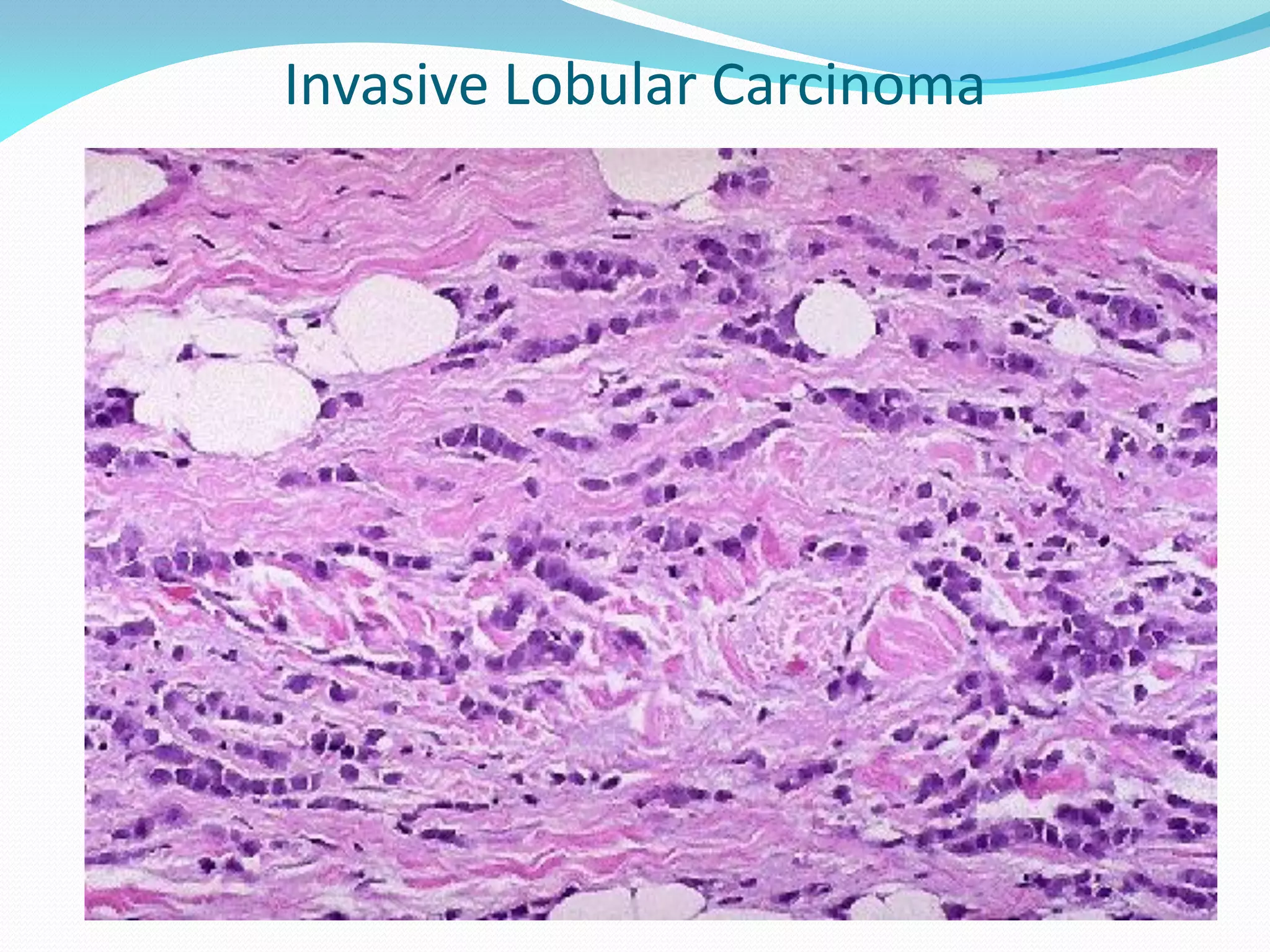 Breast pathology | PDF