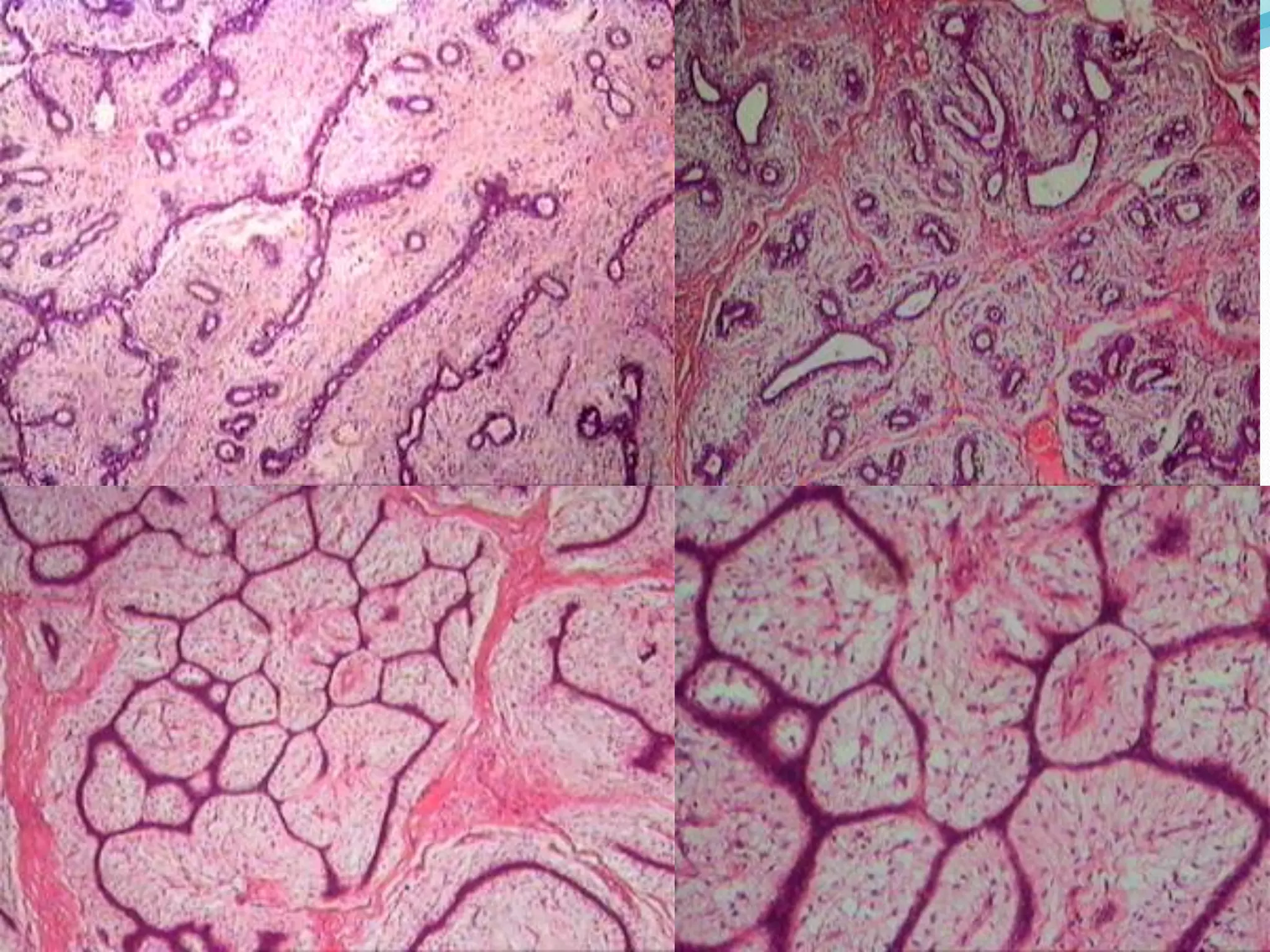 Breast pathology | PDF