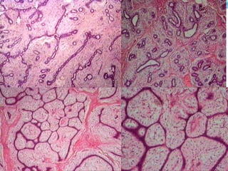 Breast pathology | PDF