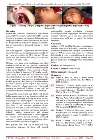 Pierre Robin Syndrome A Case Report | PDF