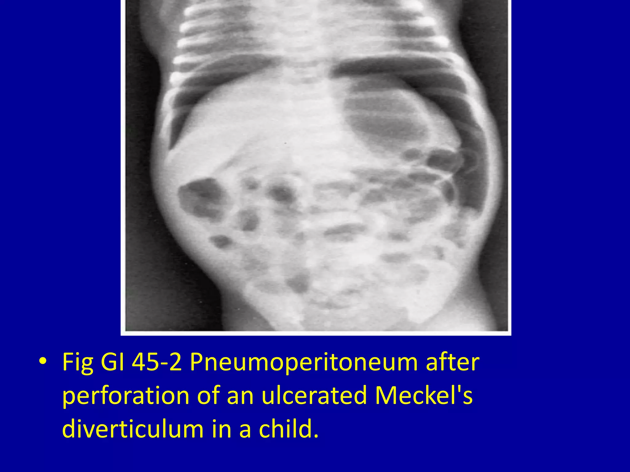 45 pneumoperitoneum | PPTX
