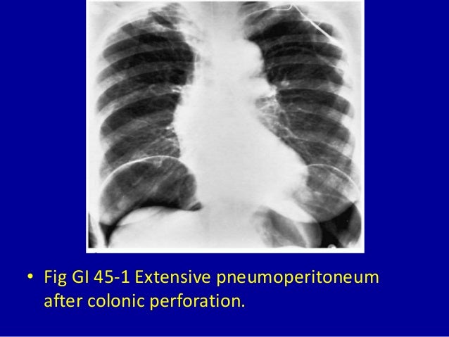 45 pneumoperitoneum