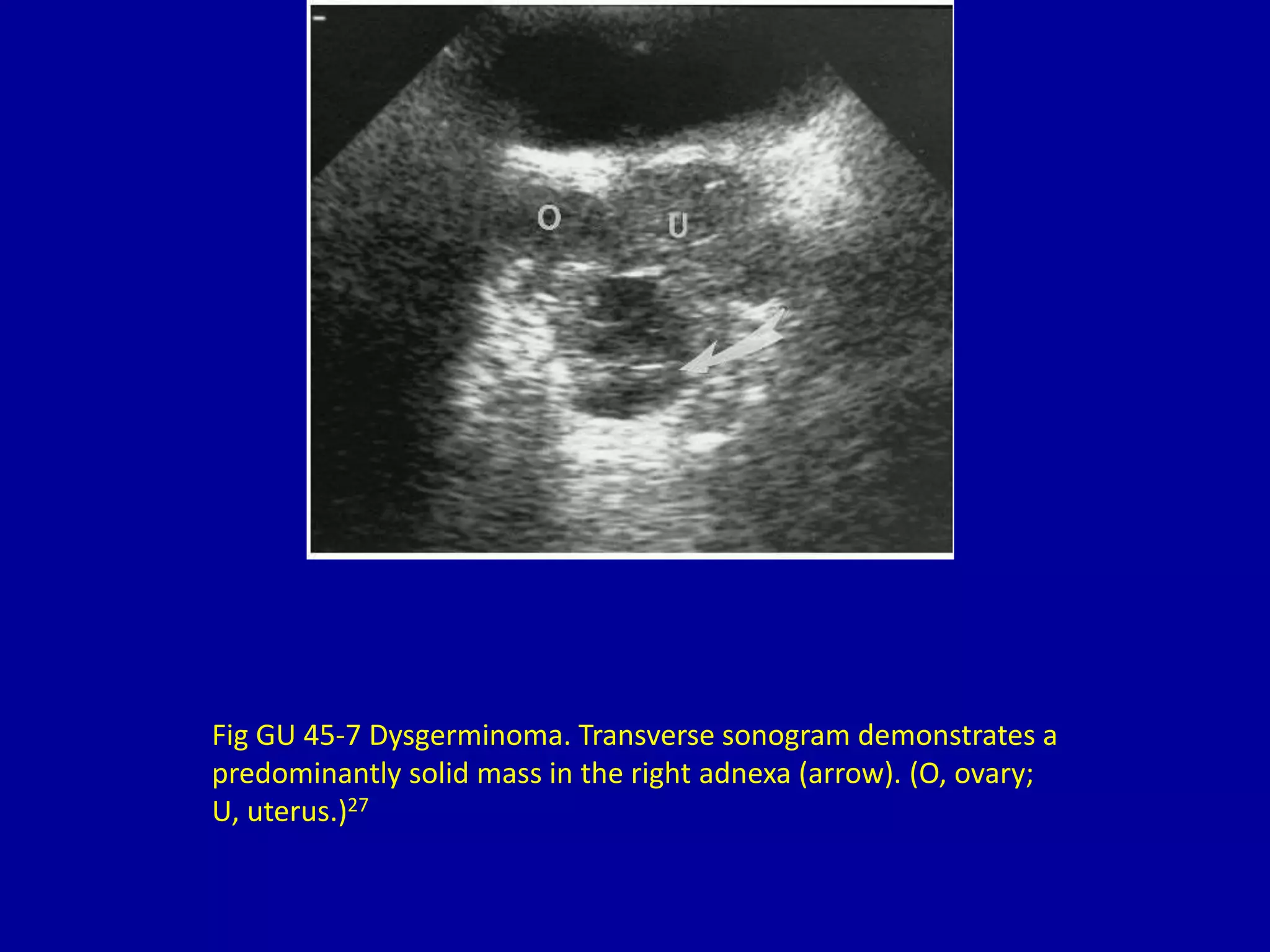 45 solid pelvic masses | PPTX