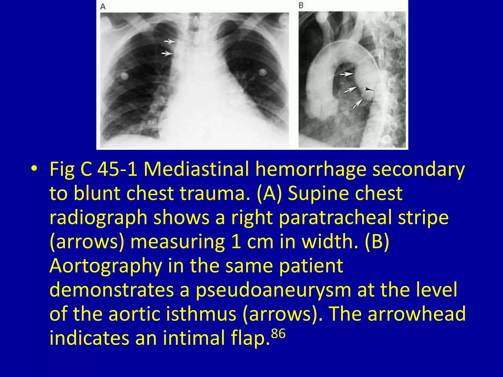 45 widening of the right paratracheal stripe ( | PPTX