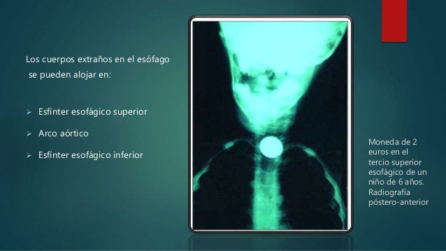 46.cuerpos extraños en el esofago