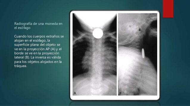46.cuerpos extraños en el esofago