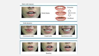 Anatomy of a smile and it's impacts of the face | PDF