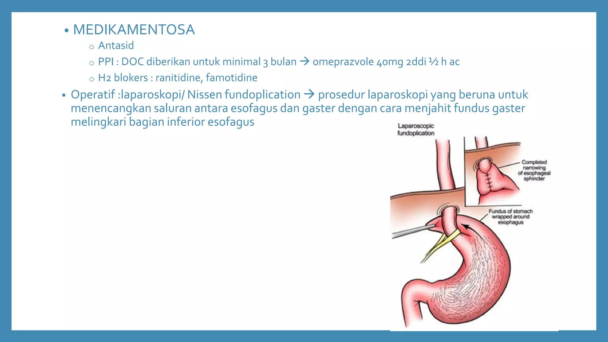 CBD laryngopharyngeal reflux | PPTX