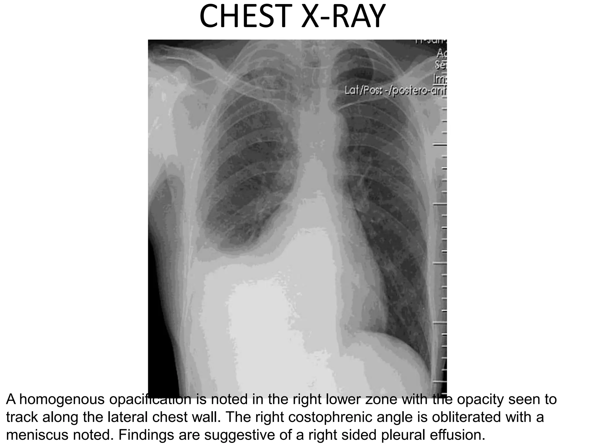 466841108-1-pleural-effusion-ppt.ppt..... | PPT | Lung and Respiratory ...