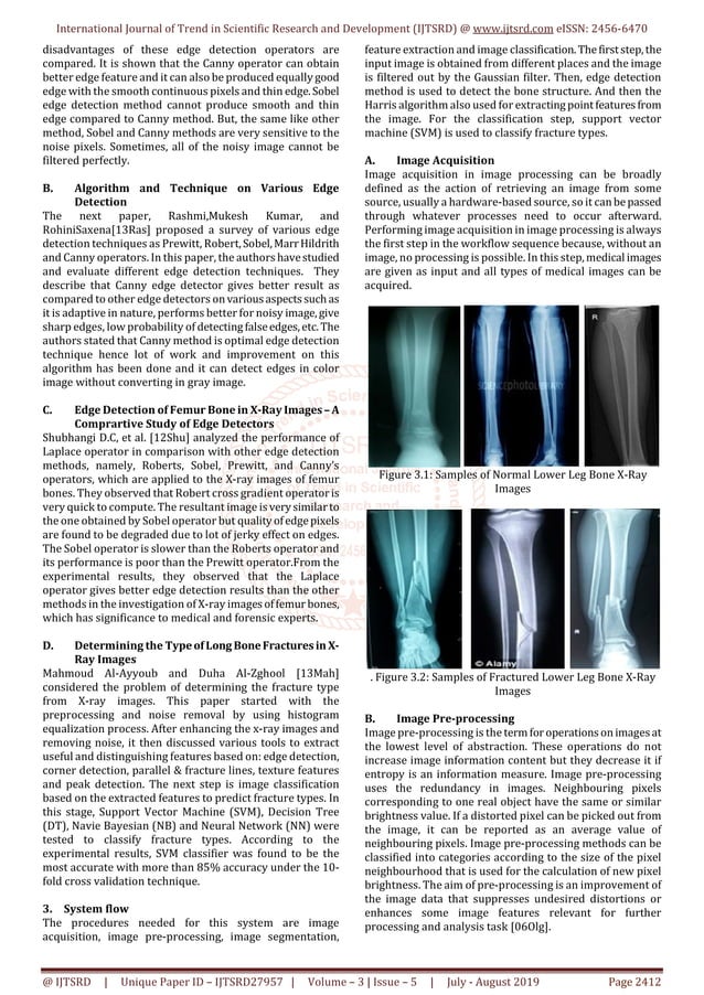Implementation of Lower Leg Bone Fracture Detection from X Ray Images | PDF