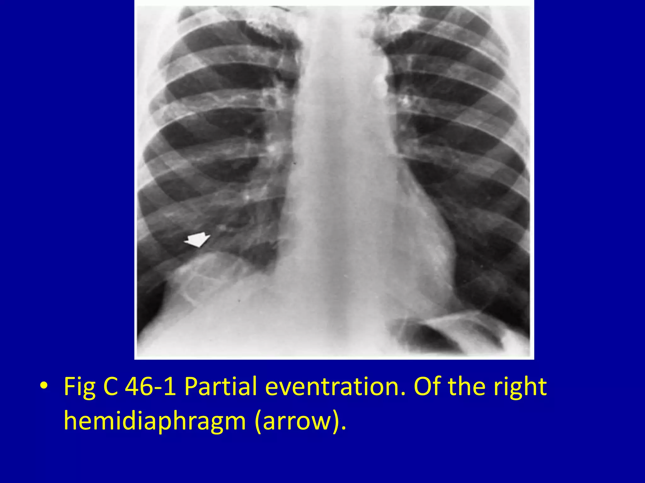46 elevated diaphragm | PPTX