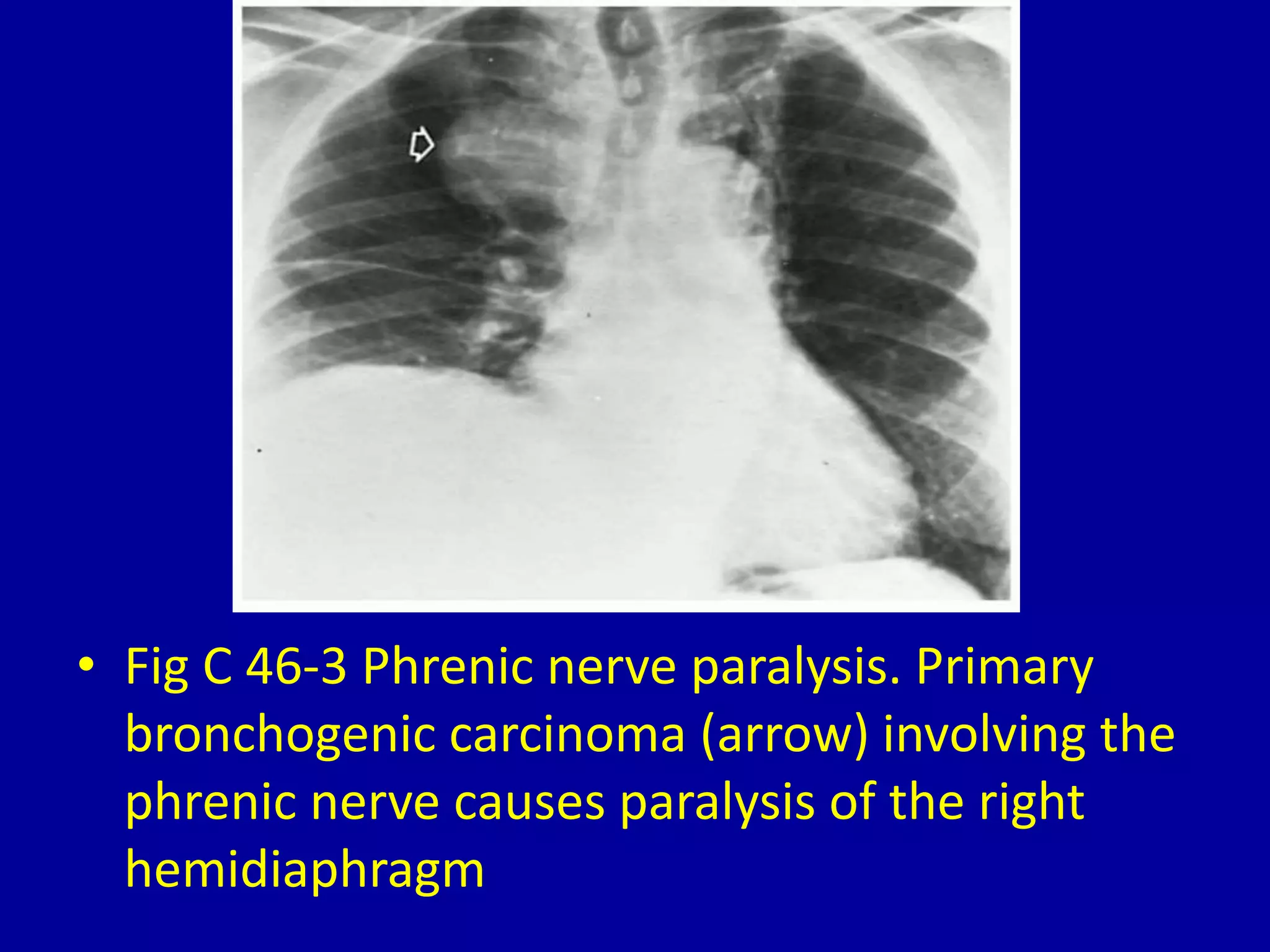 46 elevated diaphragm | PPTX