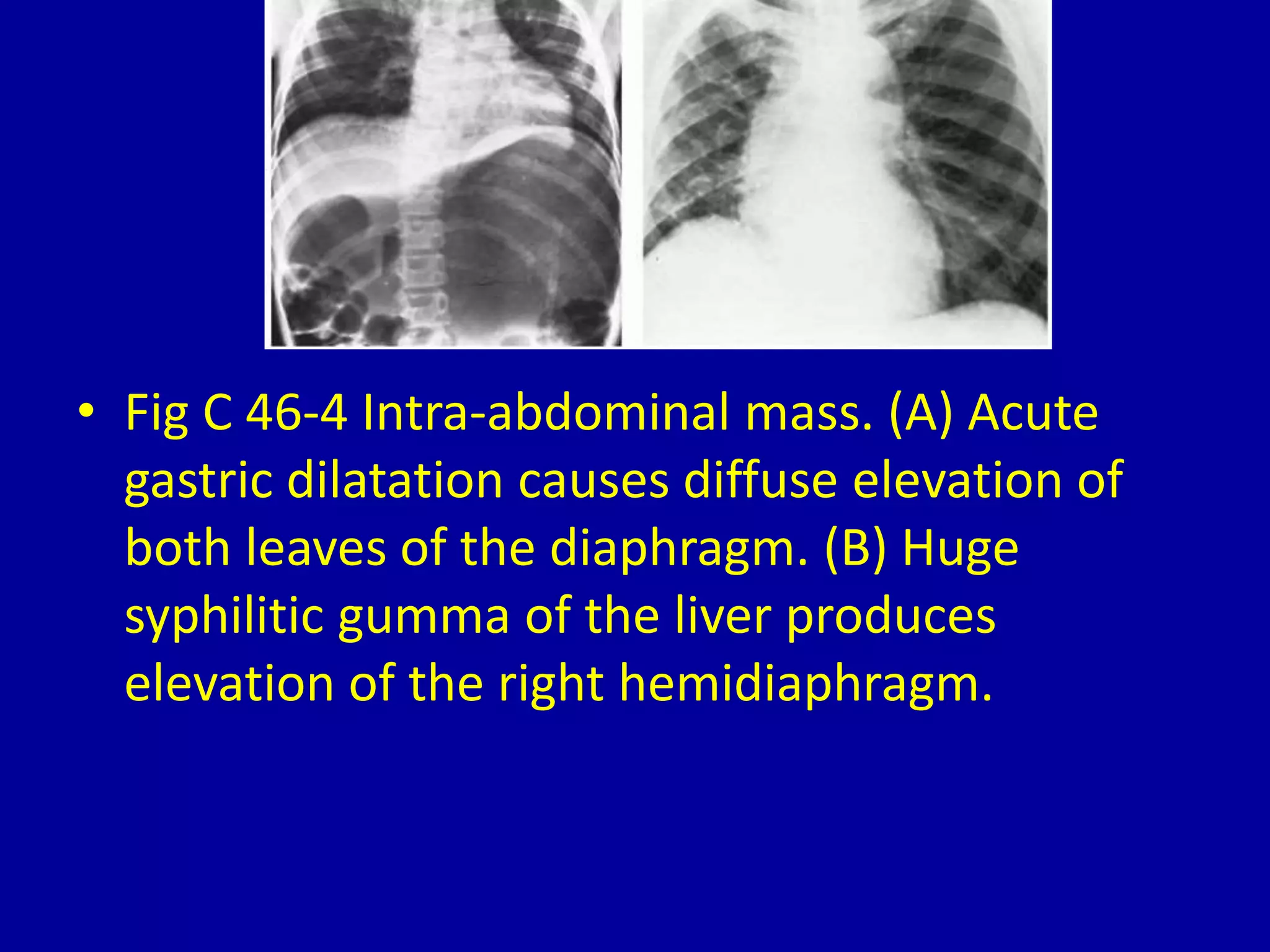 46 elevated diaphragm | PPTX