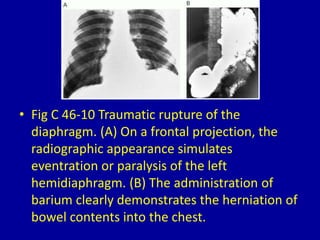 46 elevated diaphragm | PPT