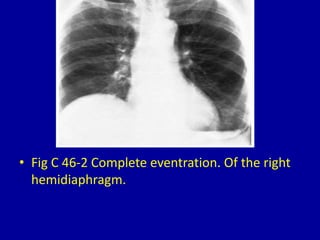 46 elevated diaphragm | PPTX