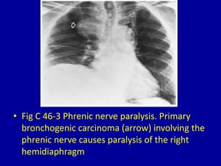 46 elevated diaphragm | PPTX