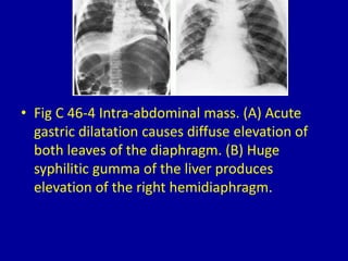 46 elevated diaphragm | PPTX