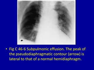 46 elevated diaphragm | PPT