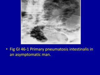 46 gas in the bowel wall (pneumatosis | PPTX