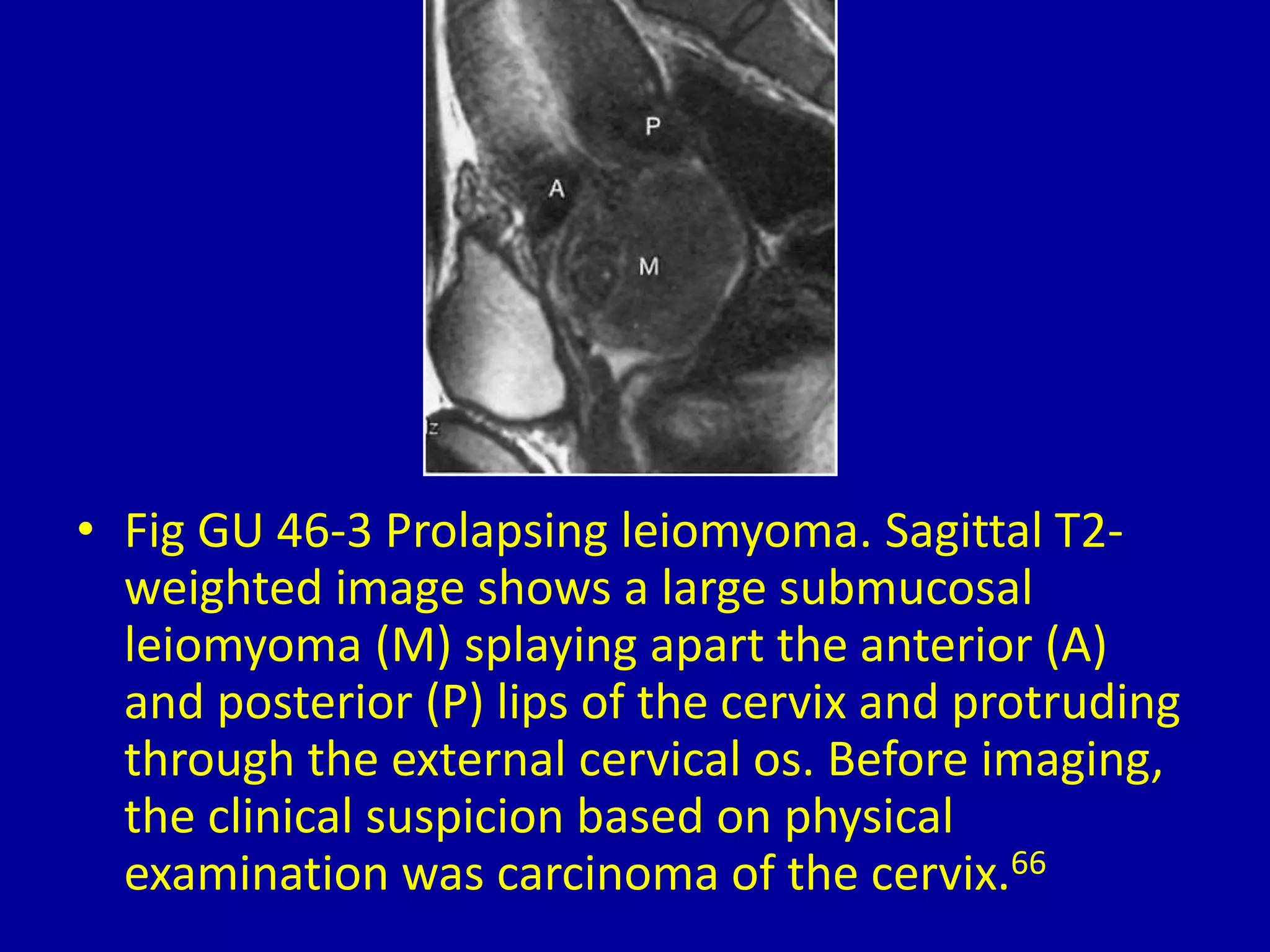 46 magnetic resonance imaging of the female pelvis | PPTX