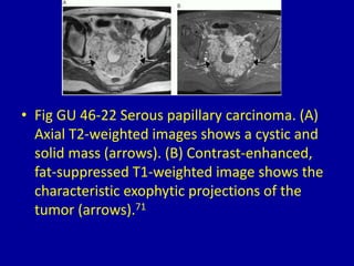 Normal Female Pelvic Mri