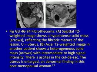 46 magnetic resonance imaging of the female pelvis | PPTX
