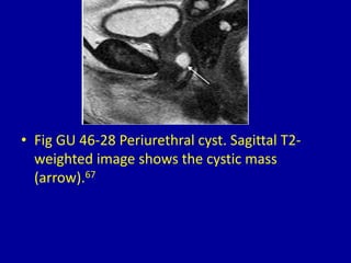 46 magnetic resonance imaging of the female pelvis | PPTX