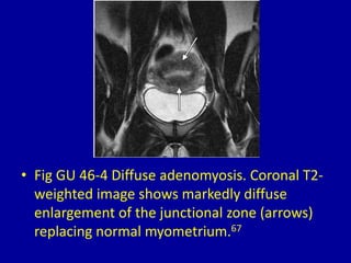 Normal Female Pelvic Mri