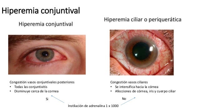 Conjuntivitis