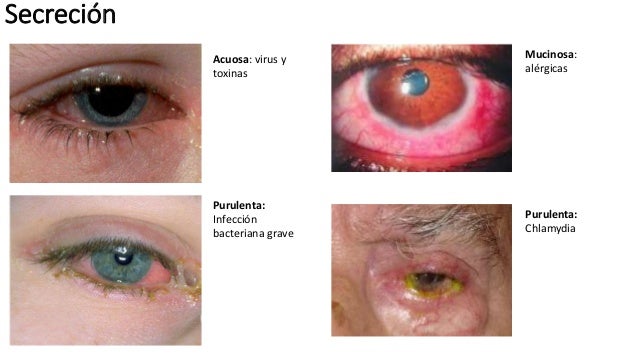 Conjuntivitis