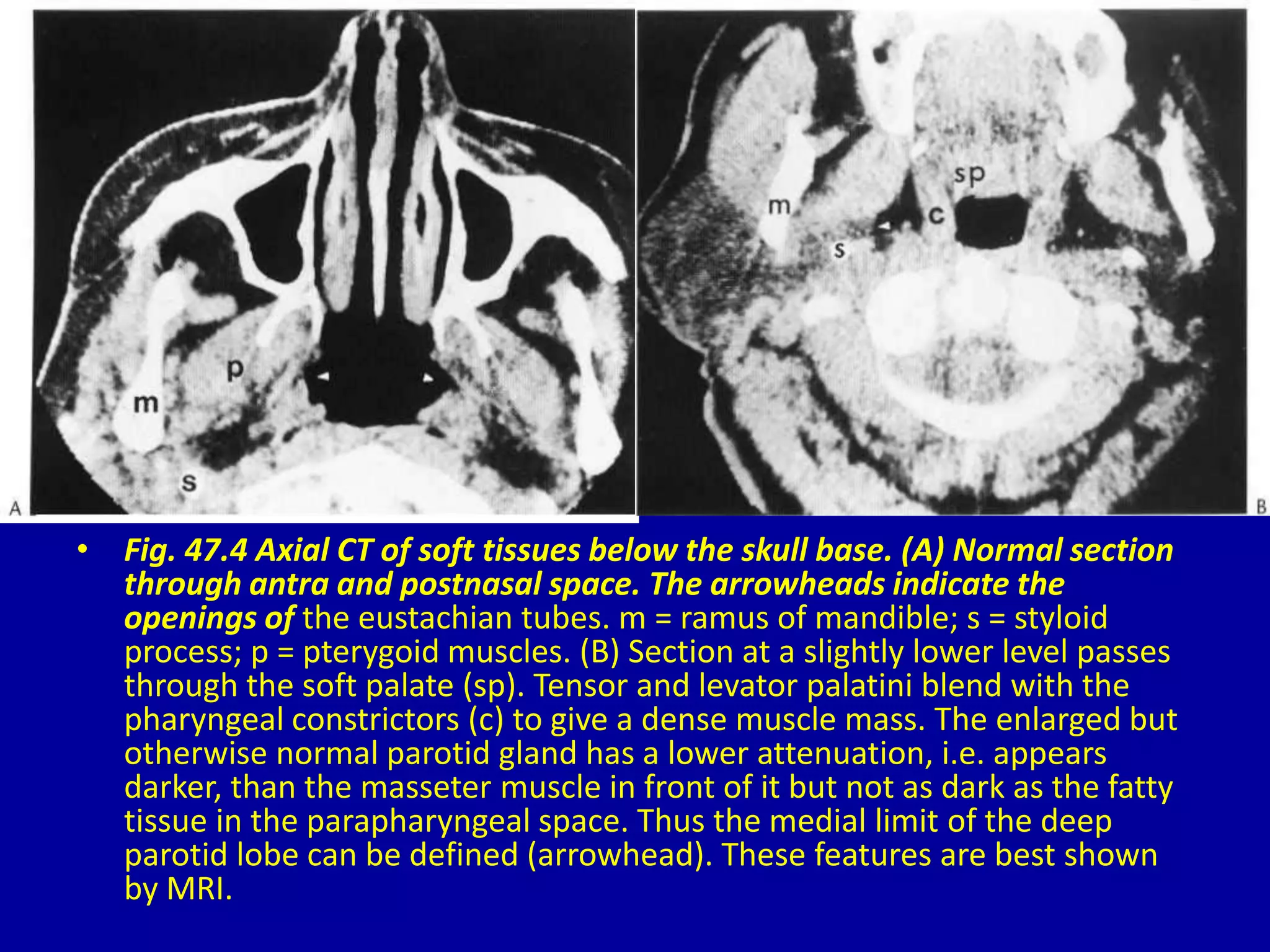 47 DAVID SUTTON PICTURES PHARYNX AND LARYNX THE NECK | PPTX | Ear, Nose ...