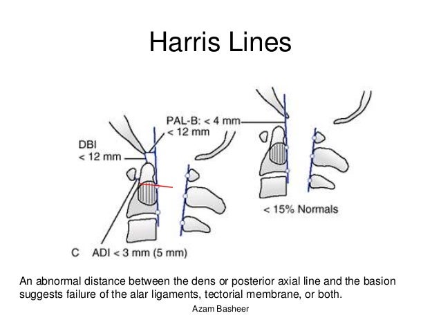 Upper C-spine Fractures Azam Basheer
