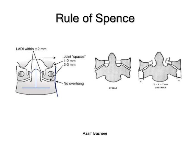 Upper C-spine Fractures Azam Basheer