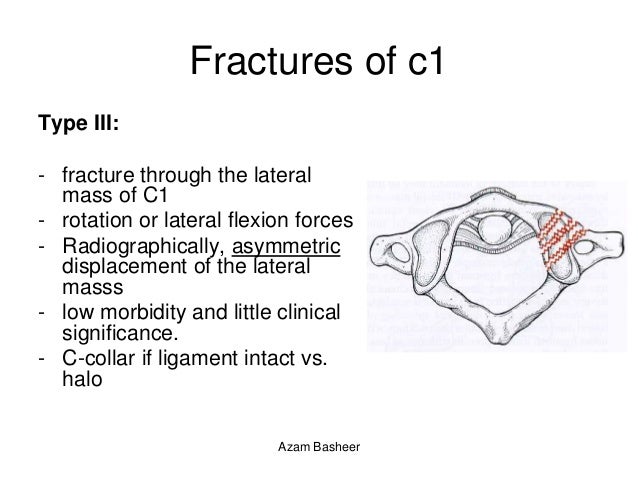 Upper C-spine Fractures Azam Basheer