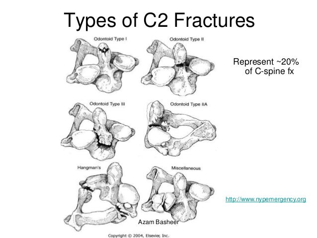 Upper C-spine Fractures Azam Basheer