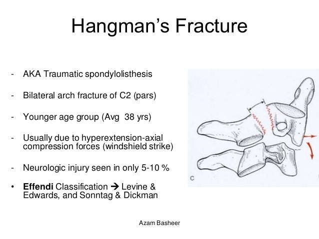 Upper C-spine Fractures Azam Basheer