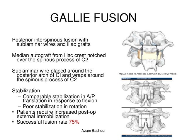 Upper C-spine Fractures Azam Basheer