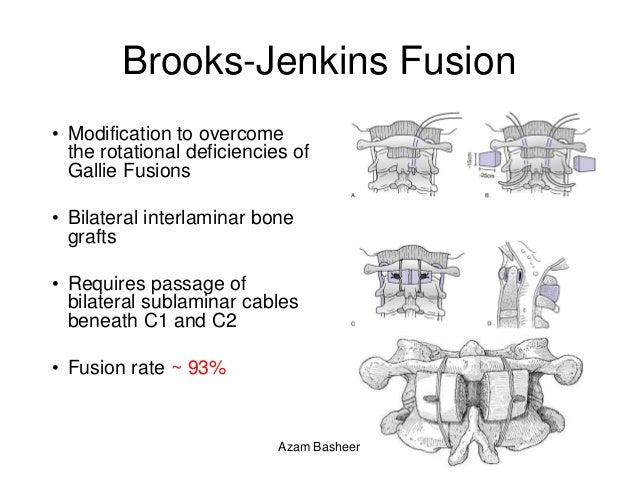 Upper C-spine Fractures Azam Basheer