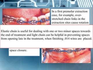 Friction vs Friction less mechanics in orthodontic space closure | PPTX