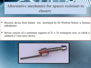 Friction vs Friction less mechanics in orthodontic space closure | PPTX