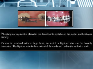 Friction vs Friction less mechanics in orthodontic space closure | PPTX
