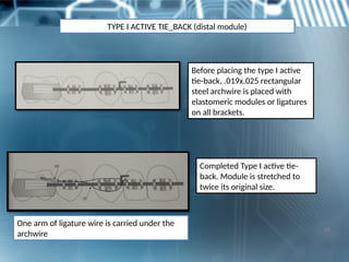 Friction vs Friction less mechanics in orthodontic space closure | PPTX
