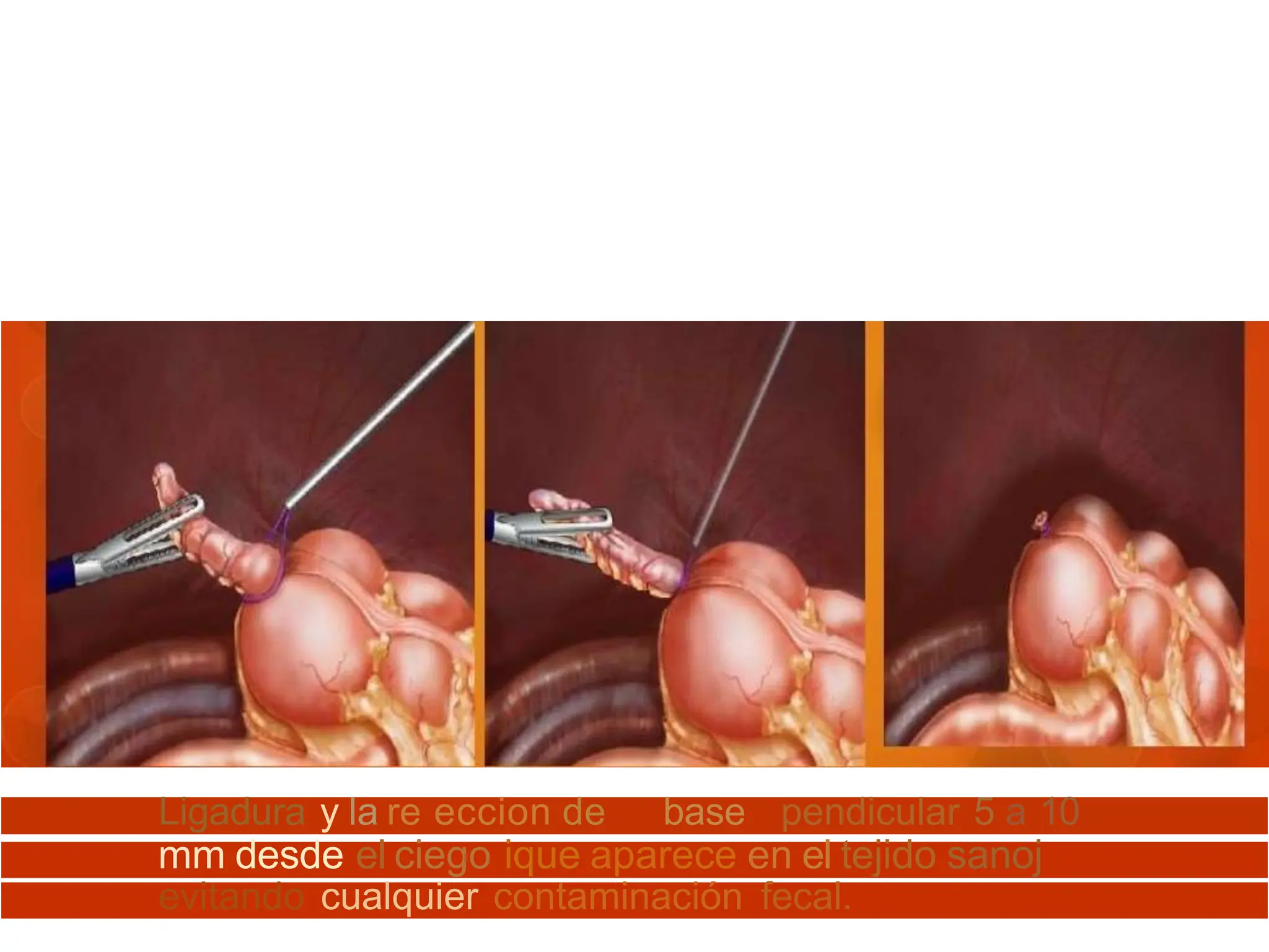 TECNICA DE APENDICECTOMIA LAPAROSCOPICA EN HOSPITAL | PPTX | Surgery ...