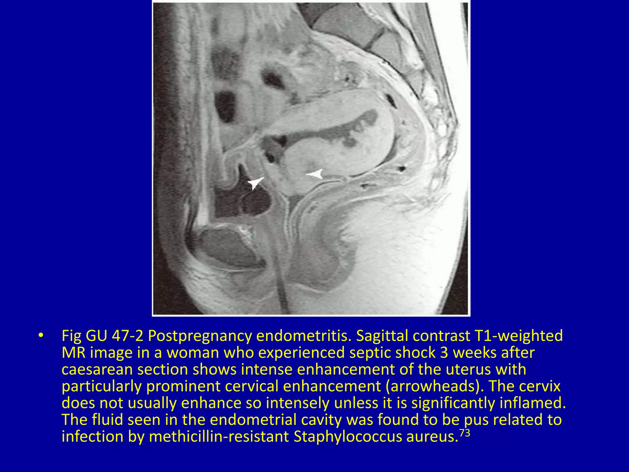 47 diffusely enlarged uterus on magnetic resonance imaging | PPT