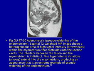 47 diffusely enlarged uterus on magnetic resonance imaging | PPTX