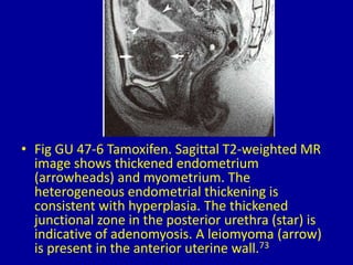 47 diffusely enlarged uterus on magnetic resonance imaging | PPTX