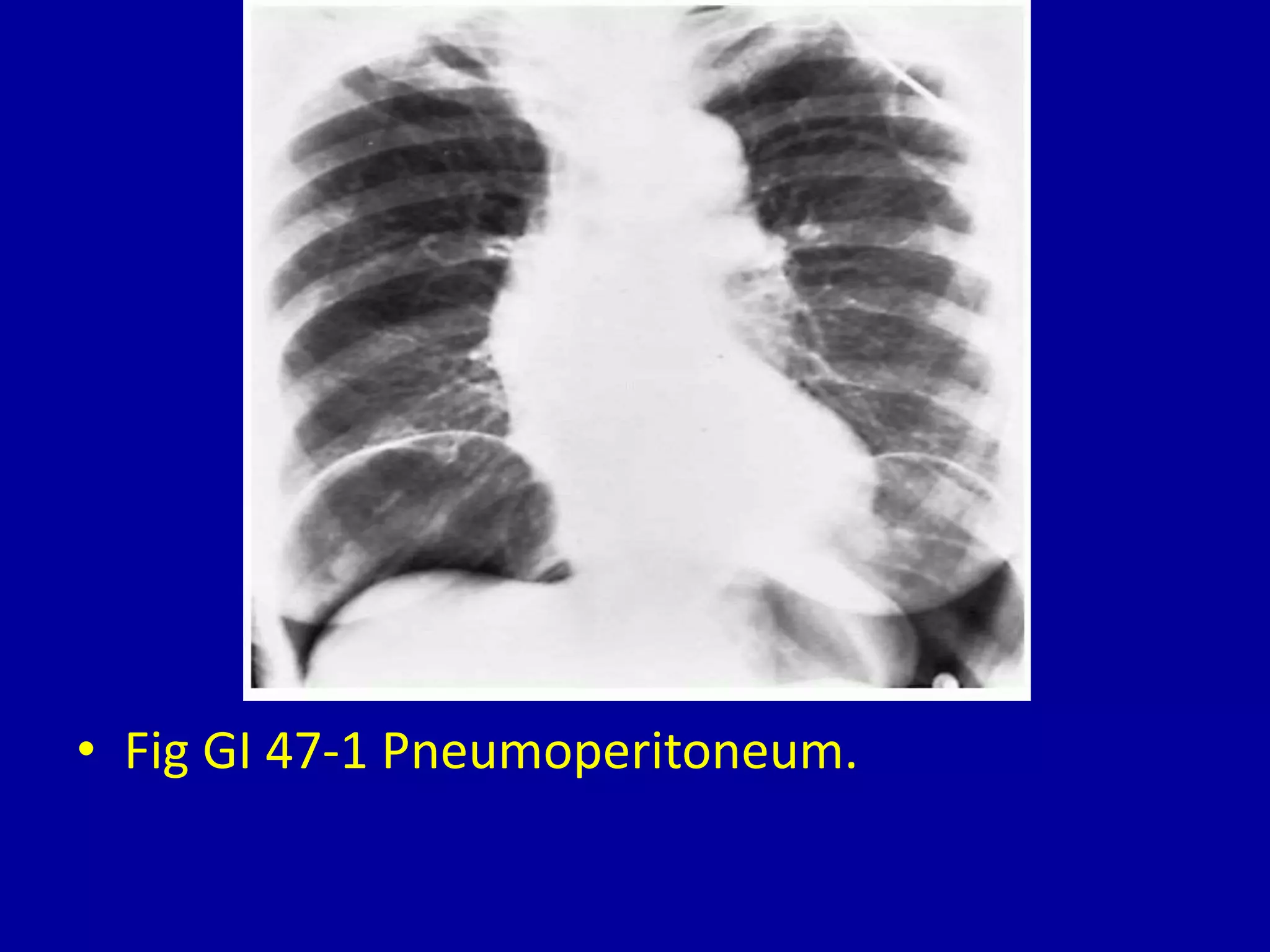 47 extraluminal gas in the upper quadrants | PPTX