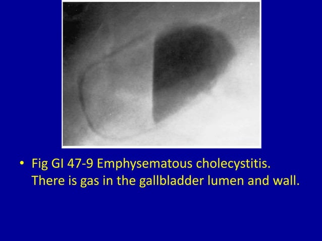 47 extraluminal gas in the upper quadrants | PPTX