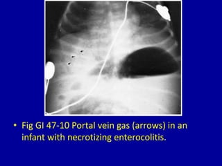47 extraluminal gas in the upper quadrants | PPTX