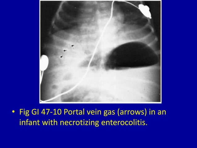 47 extraluminal gas in the upper quadrants | PPTX
